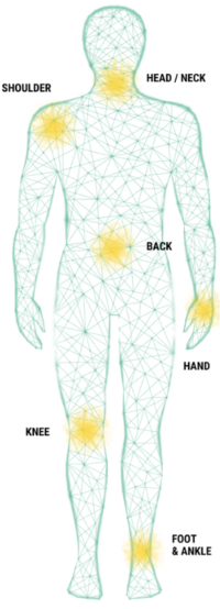 SPRINT® PNS System - Southeast Pain & Spine Care